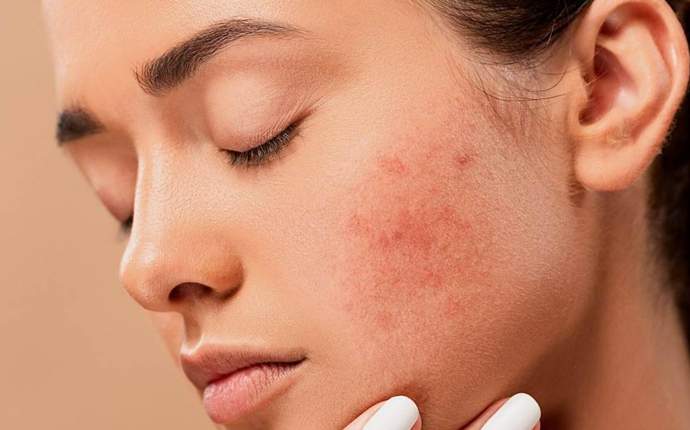 How to Win the War Against Acne | Aussie Pharmacy